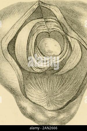 Calculi from Urinary System Stock Photo - Alamy