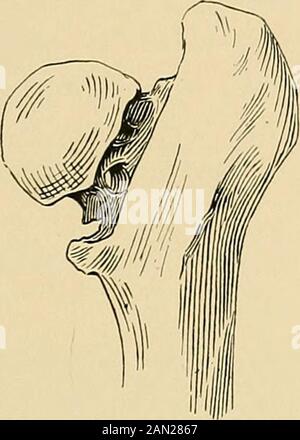 The treatment of fractures . Line of fracture. Fig. 275.—Fracture of ...
