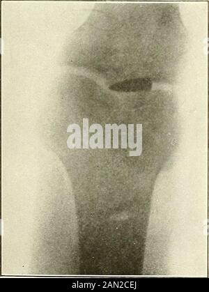 Gunshot injuries : how they are inflicted : their complications and ...