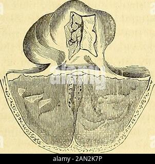 healed amputation stump Stock Photo - Alamy