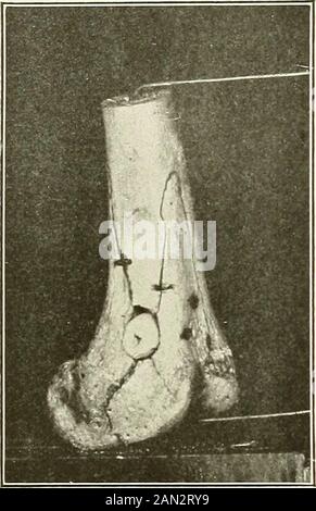 Gunshot injuries : how they are inflicted : their complications and ...