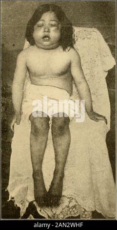 . Medical diseases of infancy and childhood. Fig. 67, Mongolian Idiot ...