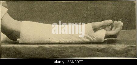 The treatment of fractures . Fig. 314.—Posterior splint padded with two ...