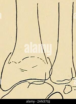 X ray Colles fracture Stock Photo - Alamy