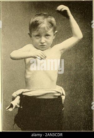 . Medical diseases of infancy and childhood. Fig. 67, Mongolian Idiot ...