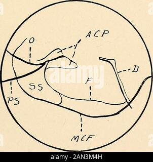 Roentgen diagnosis of diseases of the head . MCF Fig. 35.—A type of ...