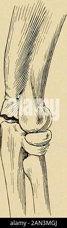 The treatment of fractures . Line of fracture. Fig. 559.—Fracture of ...