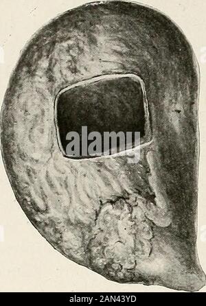 Gynaecology for students and practitioners . Fig. 240. Decidual Cast ...