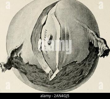 Gynaecology for students and practitioners . Fig. 213. Interstitial ...