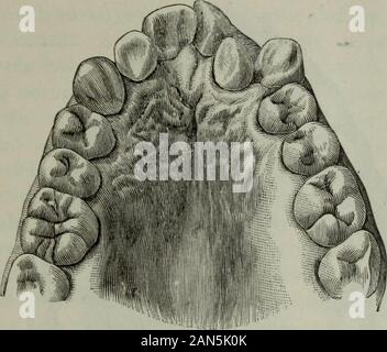 Alveolar Process Of Maxilla