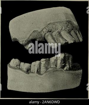 Molar teeth upper and lower right side number 13,14,18,19, and 20. one ...