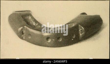 Plaster cast of the jaw in the articulator in the prosthetic workshop ...