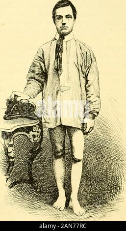 Excision of the knee joint with report of twenty-eight cases . EXCISION ...