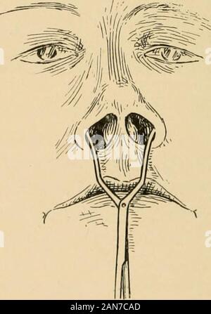 The treatment of fractures . - by pushing the skin of the check upward ...