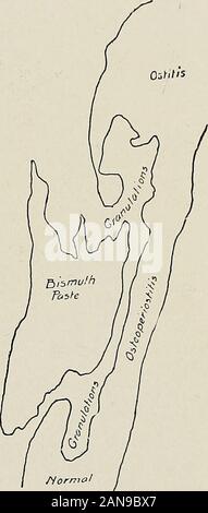 Bismuth paste in chronic suppurations, its diagnostic importance and ...