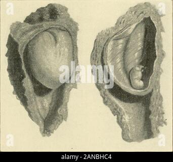 A textbook of obstetrics . Fig. III. — Decidua vera, decidua reflexa ...