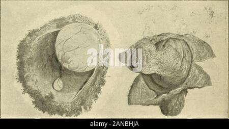 A textbook of obstetrics . Fig. III. — Decidua vera, decidua reflexa ...