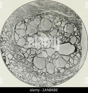 Follicles of colloid in thyroid Stock Photo - Alamy