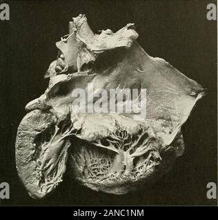 CONGENITAL HEART MALFORMATION Stock Photo - Alamy