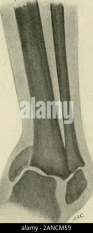 Normal lower leg, X-ray Stock Photo - Alamy