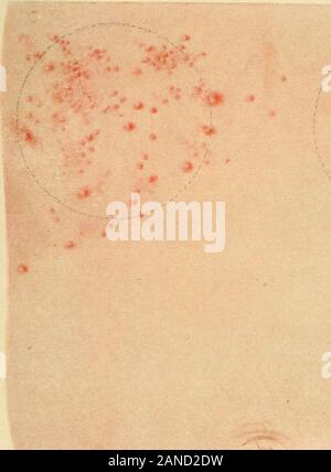 Tuberculin skin test Stock Photo - Alamy
