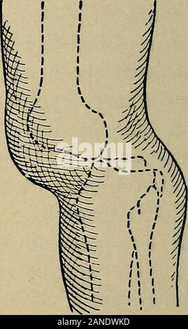 . Atlas and epitome of traumatic . Fig. 136.—Forward dislocationof the ...