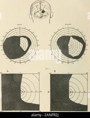 AMAarchives of neurology & psychiatry . Fig. 1 (Case 1, P. B.).—Left ...