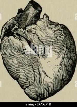 HEART SPECIMEN - PERICARDITIS Stock Photo - Alamy