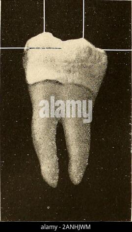 Principles and practice of operative dentistry . Mesio- buccal cusp ...