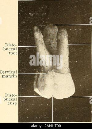 Principles and practice of operative dentistry . Lingual grooveFig. 59 ...