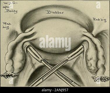 Gynecology . Fig. 289.—Baldy-Webster Operation for Retroversion.The ...