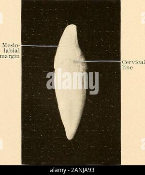 Principles and practice of operative dentistry . Mesio- buccal cusp ...