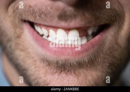 Man with missing front tooth Stock Photo - Alamy