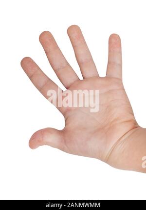 Scarlet fever. Close-up of a rash on the skin of a 15-year-old female ...