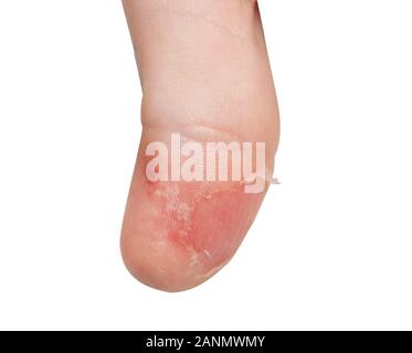 Scarlet fever. Close-up of a rash on the skin of a 15-year-old female ...