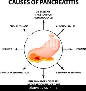 Symptoms of pancreatitis. The structure of the stomach and pancreas ...