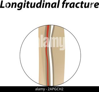 Longitudinal bone fracture. Infographics. Vector illustration on a ...