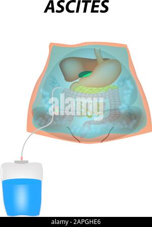 Ascites Free fluid in the abdominal cavity. Infographics. Vector ...