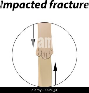 Impacted fracture Bone. Infographics. Vector illustration on a lined ...