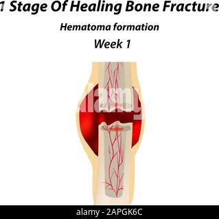 1 Stage Of Healing Bone Fracture. Formation of callus. Hematoma. The bone fracture. Infographics ...