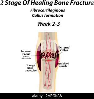 1 Stage Of Healing Bone Fracture. Formation of callus. Hematoma. The bone fracture. Infographics ...