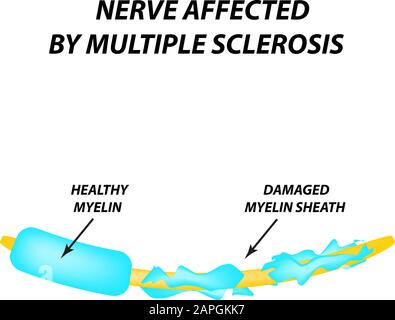 The destruction of the myelin sheath on the axon. Damaged myelin ...