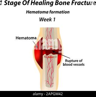 Stages Of Healing Bone Fracture. Formation of callus. The bone fracture. Infographics. Vector ...