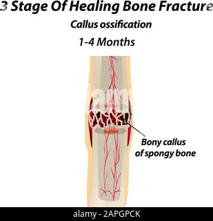 Stages Of Healing Bone Fracture. Formation of callus. The bone fracture ...