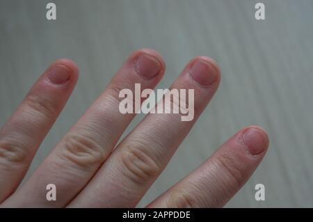 Finger nails damaged due to biting and compulsive skin picking disorder ...