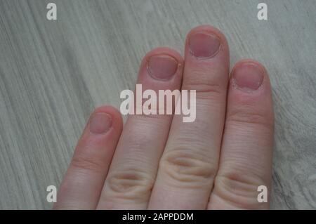 Damaged fingernails from biting due to anxiety disorders with damaged ...