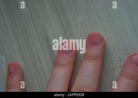 Damaged fingernails from biting due to anxiety disorders with damaged ...