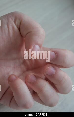Damaged fingernails from biting due to anxiety disorders with damaged ...