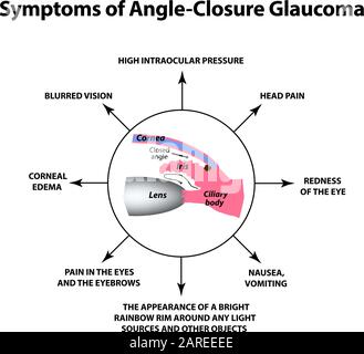 Symptoms of open-angle glaucoma. World glaucoma day. The anatomical ...