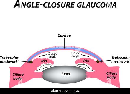 Open-angle glaucoma. A common type of glaucoma. The anatomical ...